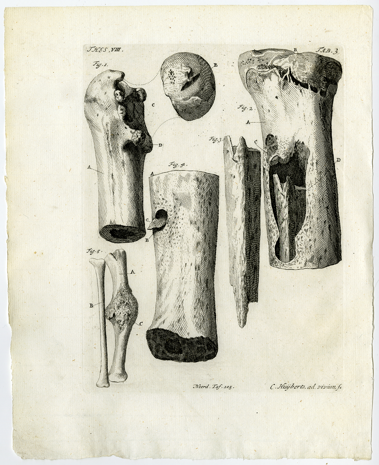 Antique Print-HUMAN LEG BONES-CARIES-DUCK WING BONE-TAB 3-Ruysch ...