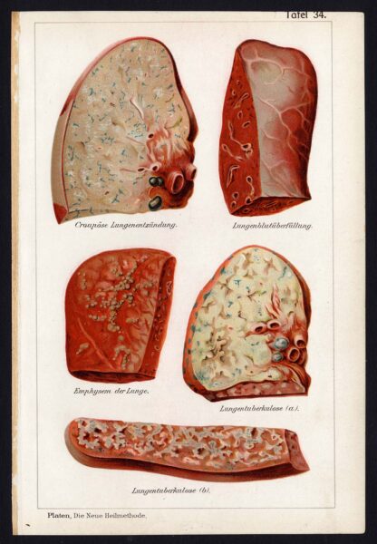 Antique Print-MEDICAL-LUNGS-PULMONARY-TUBERCULOSIS-DISEASES-Taf 34 ...